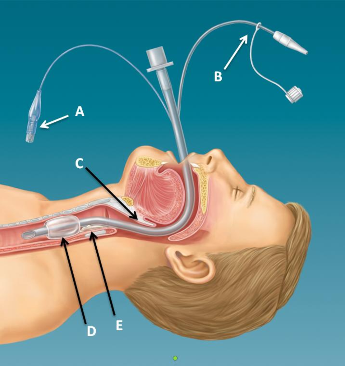 Ống NKQ Hilo Evac. - GÂY MÊ HỒI SỨC